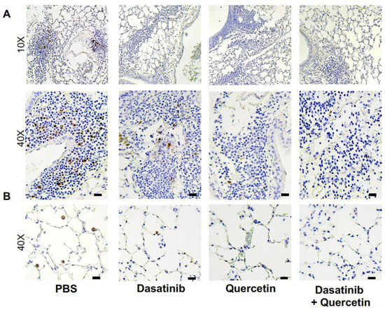 Impact of Senolytic Treatment on Gene Expression in Aged Lung