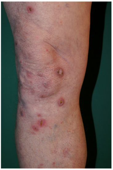 Skin Microbiome in Prurigo Nodularis