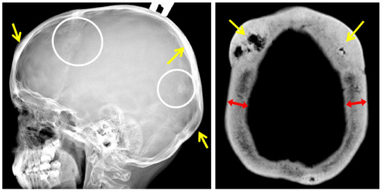 Clinical and Genetic Characteristics of Calvarial Doughnut Lesions with ...