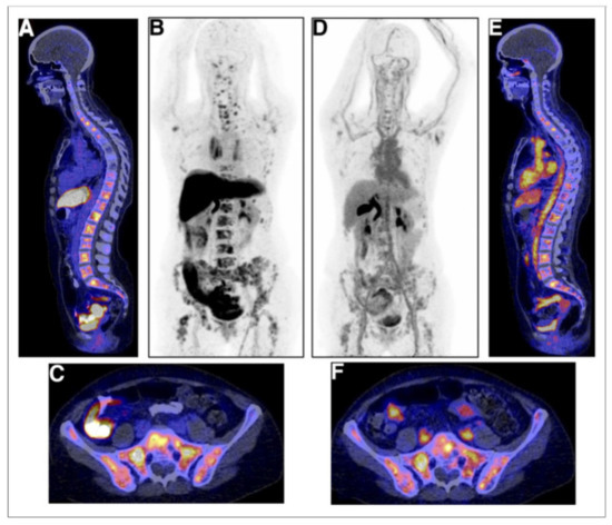 Ijms Free Full Text Androgen Receptor Imaging In The Management Of