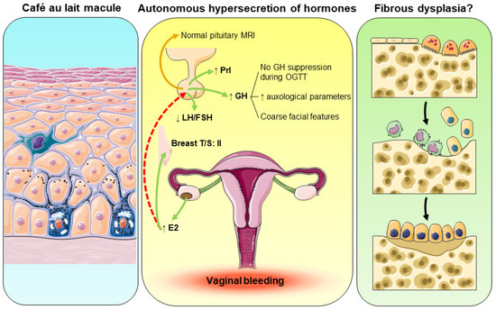 McCune–Albright Syndrome: A Case Report and Review of Literature