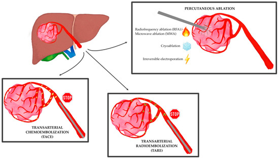 The Synergistic Effect of Interventional Locoregional Treatments and Immunotherapy for the ...