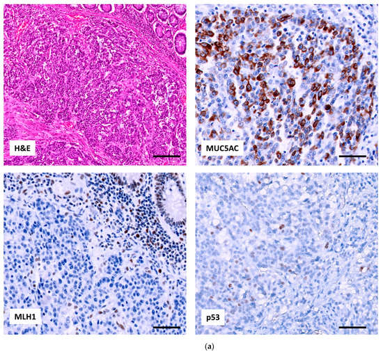Alterations in p53, Microsatellite Stability and Lack of MUC5AC ...