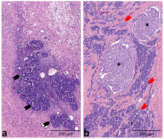 Alterations of miRNA Expression in Diffuse Hyperplastic Perilobar ...
