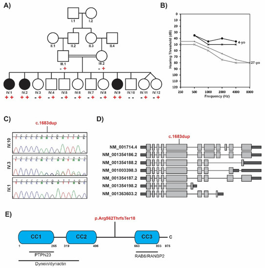 Biallelic Loss-of-Function Variants in BICD1 Are Associated with ...