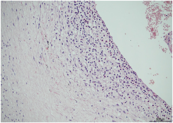 Discordant Eosinophilic/T-Cell Chorionic Vasculitis in a Dichorionic ...