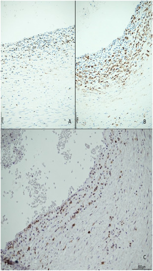 Discordant Eosinophilic/T-Cell Chorionic Vasculitis in a Dichorionic ...