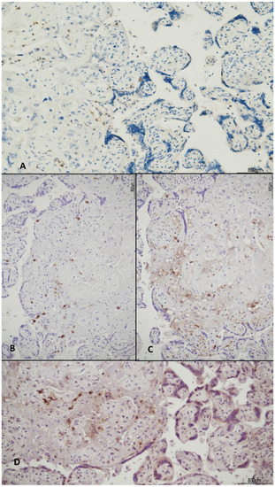 Discordant Eosinophilic/T-Cell Chorionic Vasculitis in a Dichorionic ...