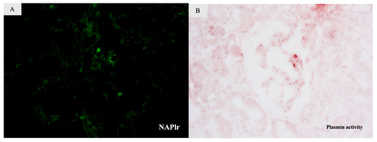 Infection-Related Cryoglobulinemic Glomerulonephritis with Serum Anti ...