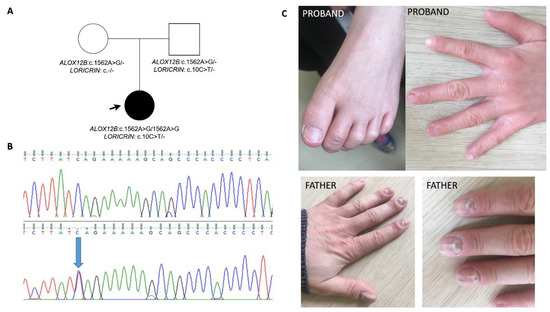 The Epidermal Transcriptome Analysis of a Novel c.639_642dup LORICRIN ...