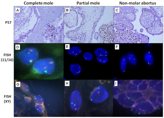 Diagnostic Utility of TSSC3 and RB1 Immunohistochemistry in ...