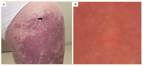 Mastocytosis and Skin Cancer: The Current State of Knowledge