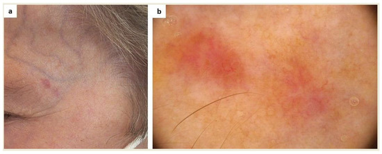 Mastocytosis and Skin Cancer: The Current State of Knowledge