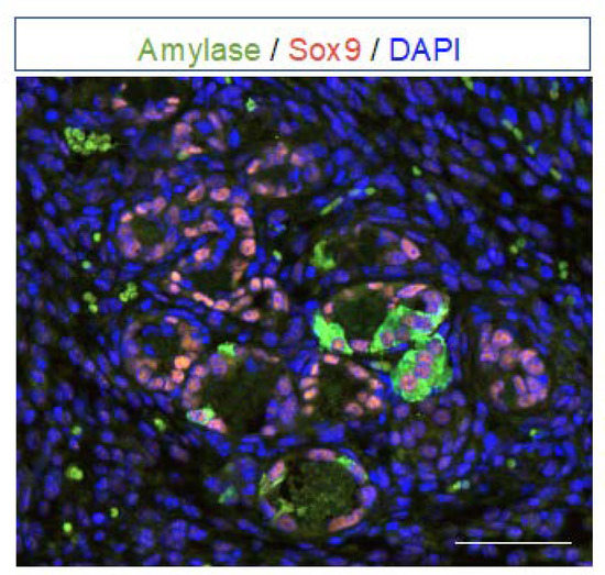 Acinar-to-Ductal Metaplasia (ADM): On the Road to Pancreatic ...
