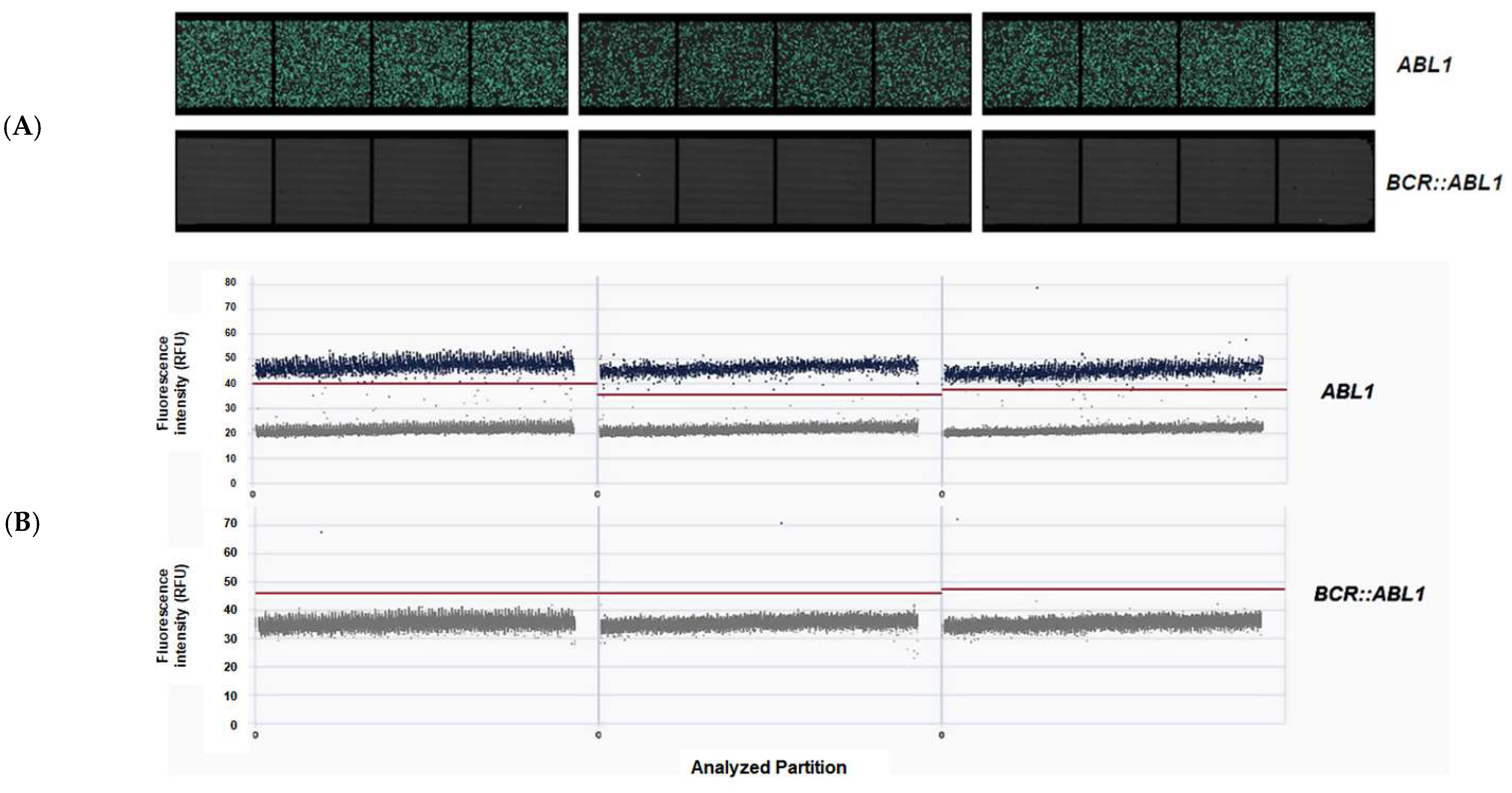 Molecular BCR::ABL1 Quantification and ABL1 Mutation Detection as Essential Tools for the ...