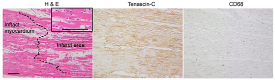 Tenascin-C in Tissue Repair after Myocardial Infarction in Humans
