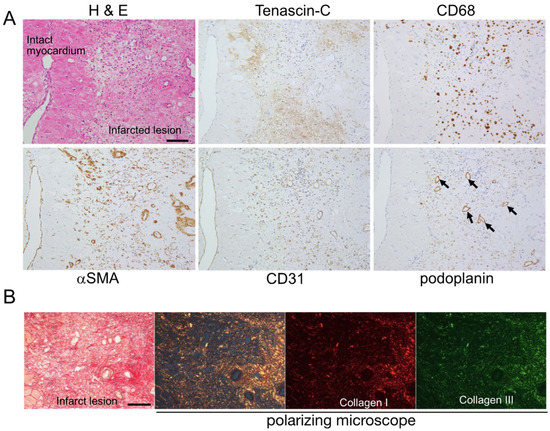 Tenascin-C in Tissue Repair after Myocardial Infarction in Humans
