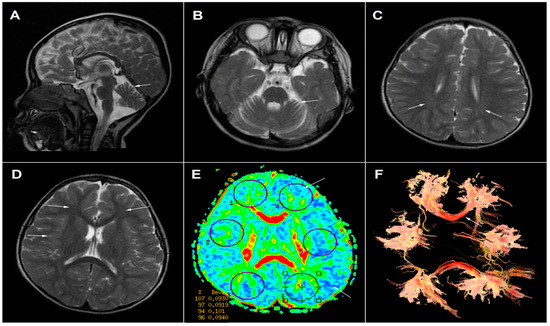 Delayed Biotin Therapy in a Child with Atypical Profound Biotinidase ...