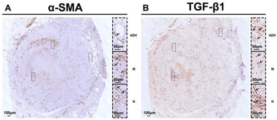 The Role of TGF-β Signaling in Saphenous Vein Graft Failure after ...