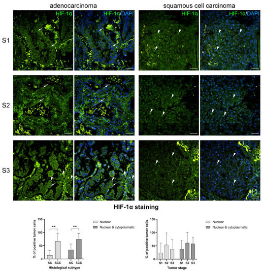 The Effect of GLUT1 and HIF-1α Expressions on Glucose Uptake and ...