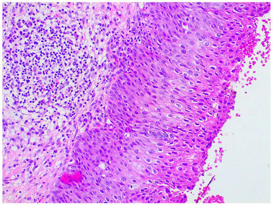 BDNF and NGF Expression in Preneoplastic Cervical Disease According to ...