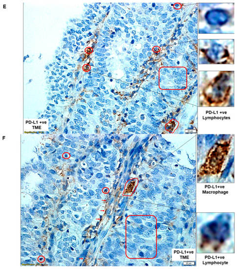 Tumor-TME Bipartite Landscape of PD-1/PD-L1 in Endometrial Cancers