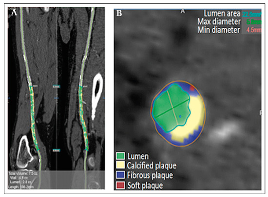 Multi-Modality Imaging of Atheromatous Plaques in Peripheral Arterial ...