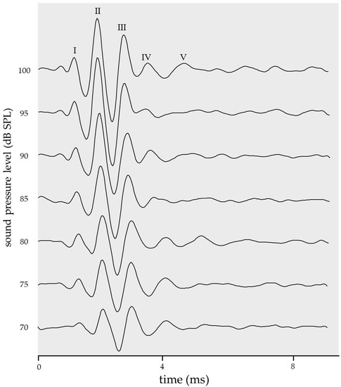 Quantitative Threshold Determination of Auditory Brainstem Responses in Mouse Models