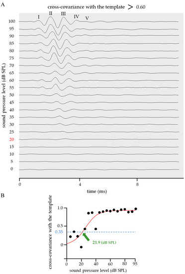 Quantitative Threshold Determination of Auditory Brainstem Responses in ...