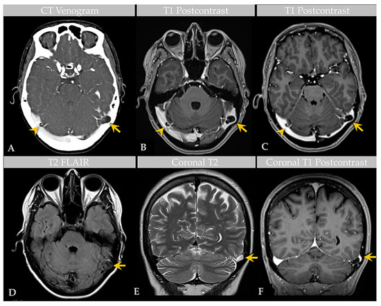Giant Arachnoid Granulations: Diagnostic Workup and Characterization in ...