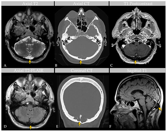 Giant Arachnoid Granulations: Diagnostic Workup and Characterization in ...