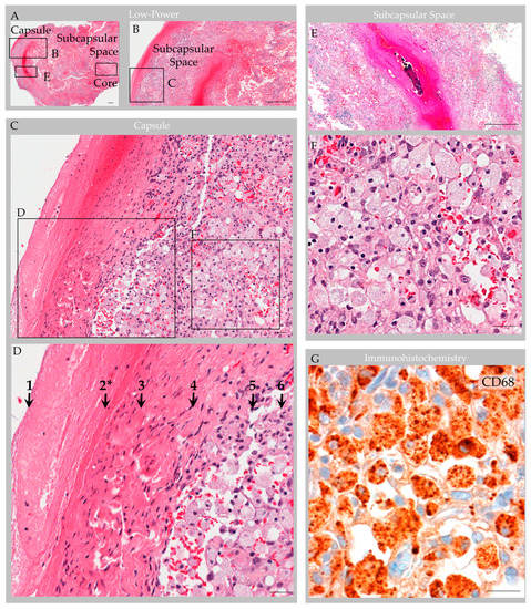 Giant Arachnoid Granulations: Diagnostic Workup and Characterization in ...