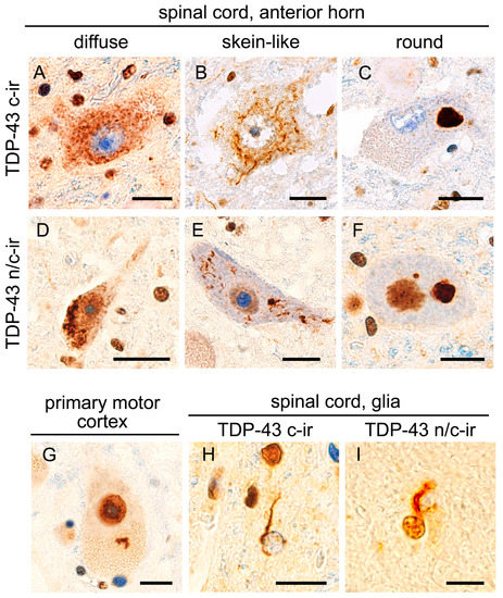 Nuclear Expression of TDP-43 Is Linked with Morphology and ...