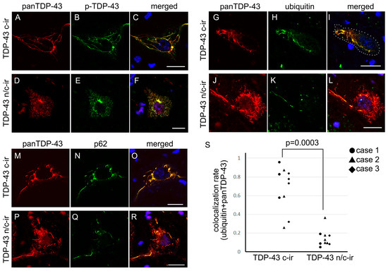 Nuclear Expression of TDP-43 Is Linked with Morphology and ...