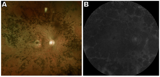 Primary versus Secondary Elevations in Fundus Autofluorescence