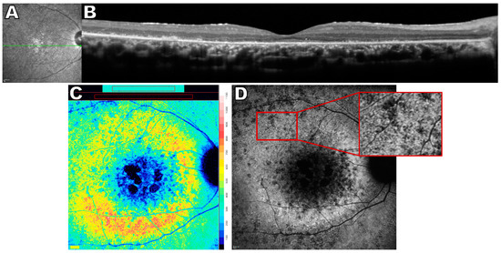 Primary versus Secondary Elevations in Fundus Autofluorescence