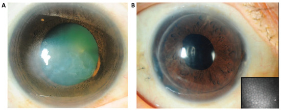 Corneal Endothelial-like Cells Derived from Induced Pluripotent Stem Cells for Cell Therapy