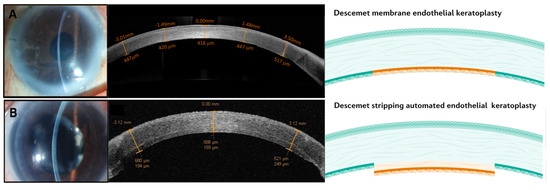 Corneal Endothelial-like Cells Derived from Induced Pluripotent Stem Cells for Cell Therapy