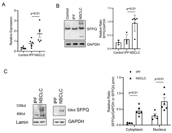 SFPQ and Its Isoform as Potential Biomarker for Non-Small-Cell Lung Cancer