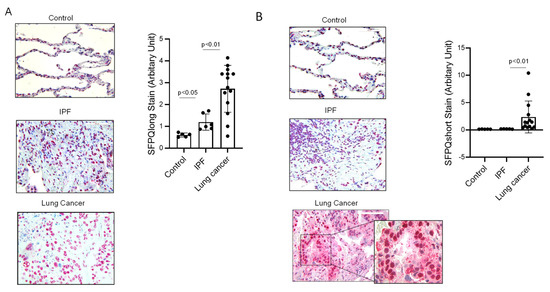 SFPQ and Its Isoform as Potential Biomarker for Non-Small-Cell Lung Cancer