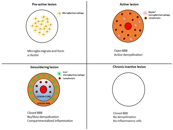 Smouldering Lesion in MS: Microglia, Lymphocytes and Pathobiochemical ...