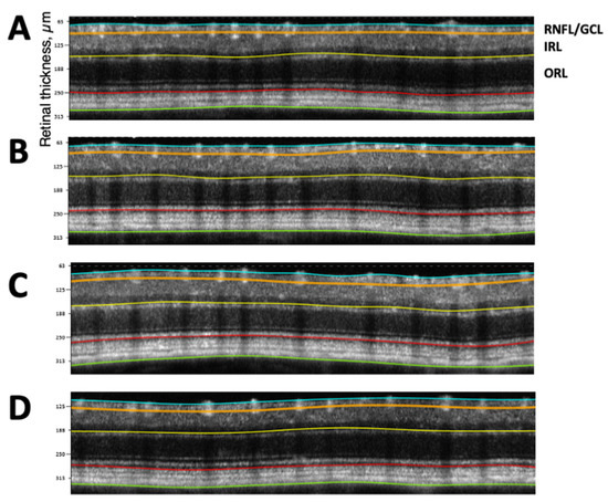 Progressive Thinning of Retinal Nerve Fiber Layer/Ganglion Cell Layer ...