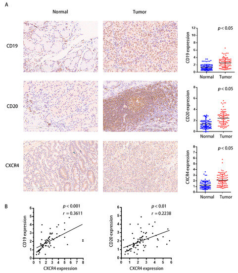 CXCR4 Expressed by Tumor-Infiltrating B Cells in Gastric Cancer Related ...