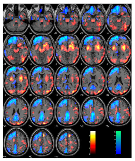 IJMS | Free Full-Text | Metabolic Brain Changes Can Predict the ...