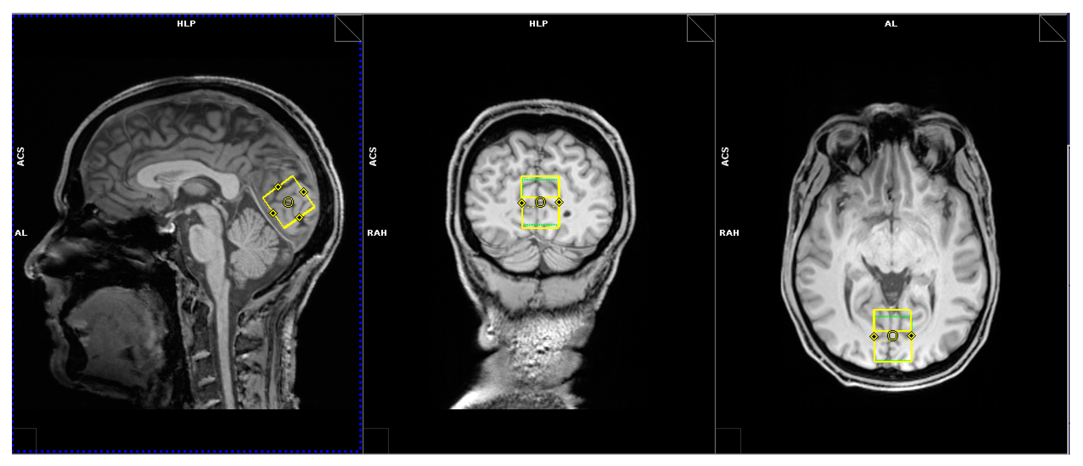 Ethanol Kinetics in the Human Brain Determined by Magnetic Resonance ...