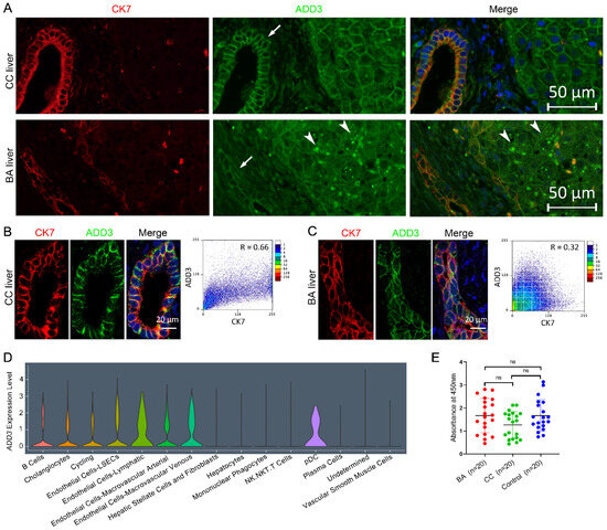 Contribution of ADD3 and the HLA Genes to Biliary Atresia Risk in Chinese