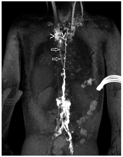Non-Contrast MR Lymphography and Intranodal Dynamic Contrast MR ...