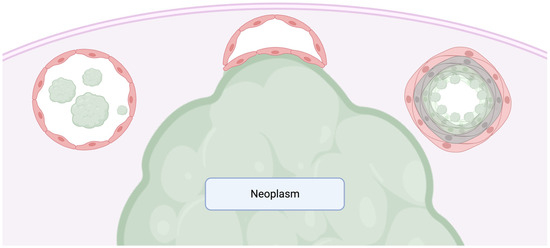 The Usefulness of Elastin Staining to Detect Vascular Invasion in Cancer