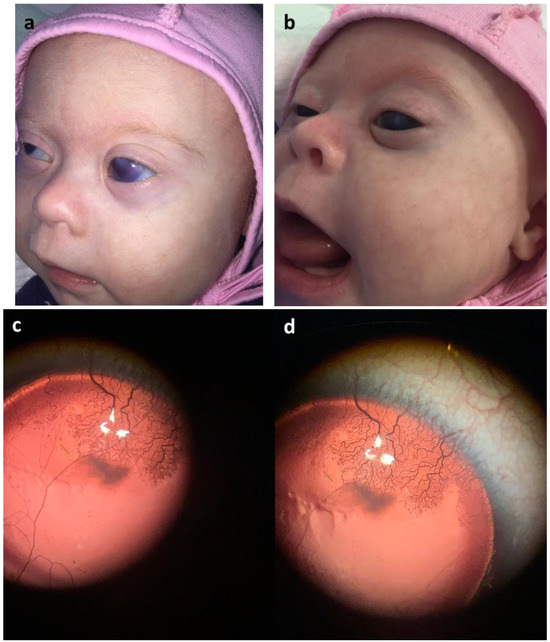 Co-Occurrence of Congenital Aniridia Due to Nonsense PAX6 Variant p ...