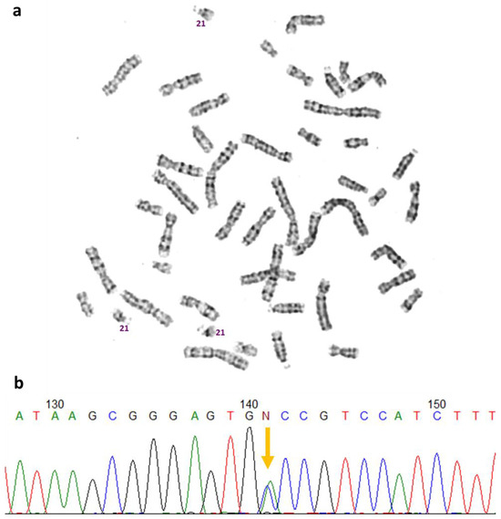 Co-Occurrence of Congenital Aniridia Due to Nonsense PAX6 Variant p ...